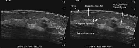 Breast Ultrasound Principles Clinical Tree