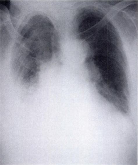 Tension Pyopneumothorax Chest