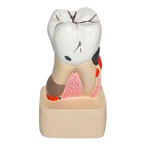 4 Times Teeth Periodontal Disease Models Human Teeth Model Medical Science Education Model