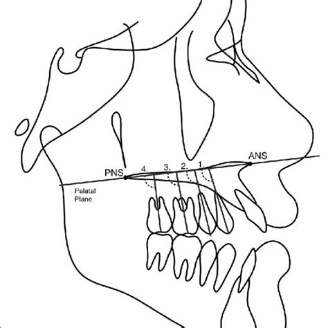 Posterior Teeth Angulations Measurements In The Maxillary Arch Related Download Scientific