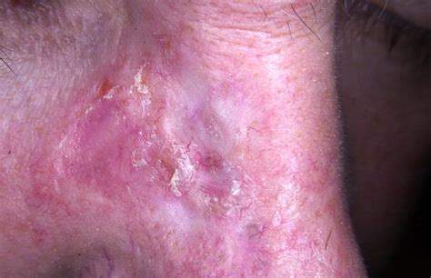 What Is Nodular And Infiltrating Basal Cell Carcinoma