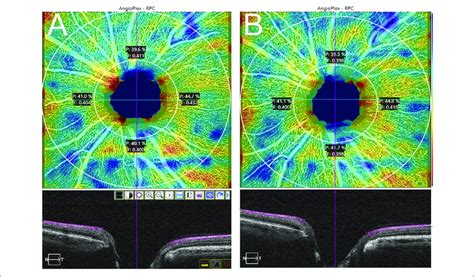 Radial Peripapillary Capillary Plexus 45 × 45 Mm Scan Plexus