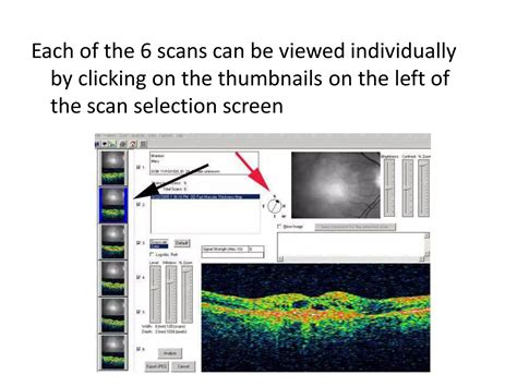 Optical Coherence Tomographyoct Macula Pptx Eye And Vision
