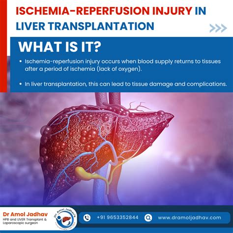 Ischemia Reperfusion Injury In Liver Transplantation Dr Amol Jadhav