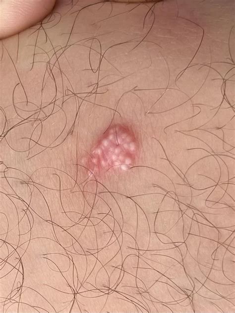 Ask Dermatology Cluster Of Raised Translucent Nodules Facebook