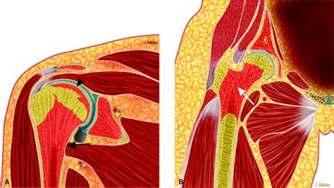 Marrow Imaging Musculoskeletal Key