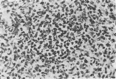 Detail Of A Small Microabscess In The T Dependent Periarteriolar Zone