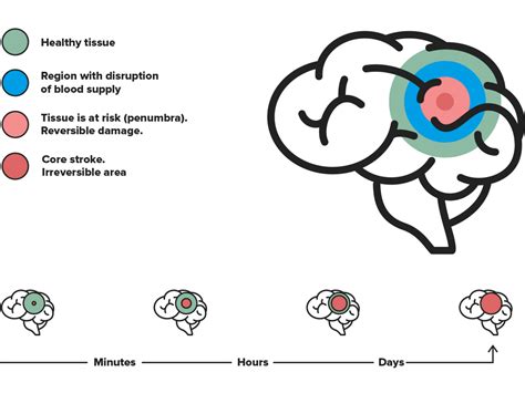 Printable Diagnosis Of Stroke