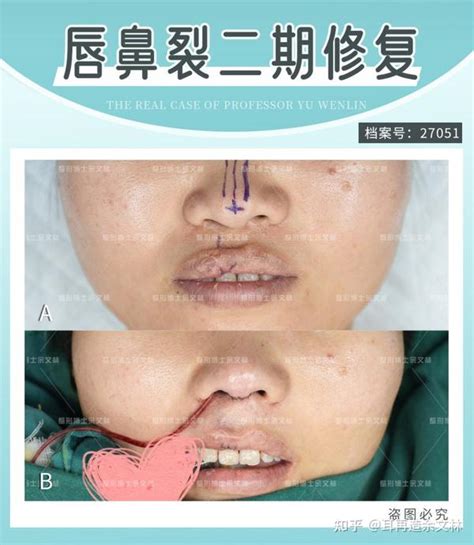 做完唇裂修复就能拥有完美唇形吗 知乎