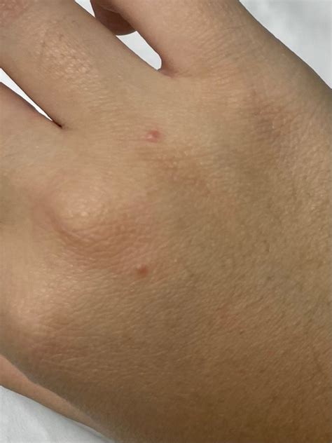 손에 빨간 점 지식in