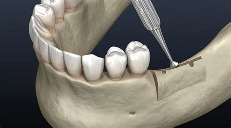 Oral Surgery Services Oral Surgeon Deer Park Il