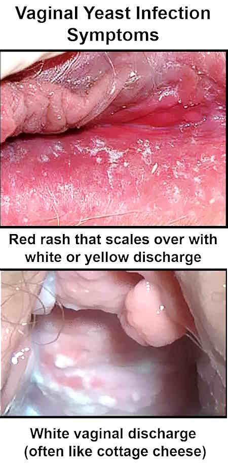 Vaginal Yeast Infections Symptoms Causes And Treatment Doctor Zara
