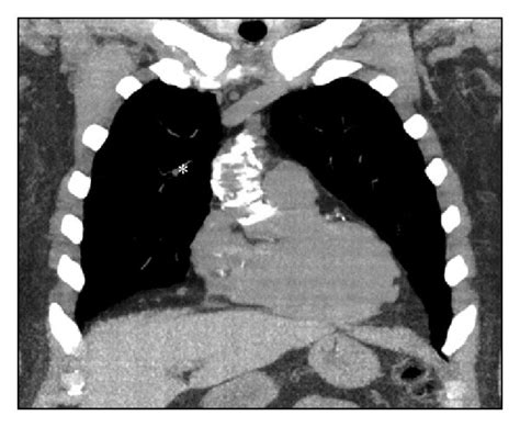 Cardiac Catheterization Shows Multivessel Coronary Artery Disease With Download Scientific