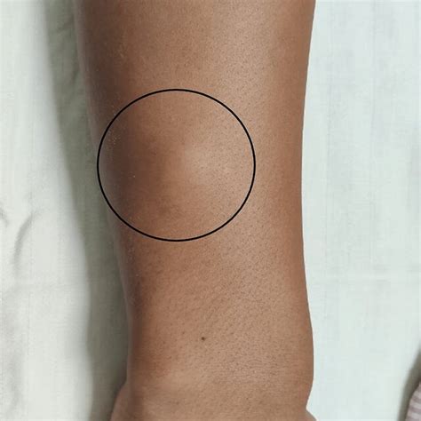 Swelling In The Right Forearm Black Circle Download Scientific Diagram