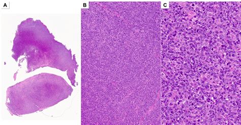 Case 1075 Adult Male With An Unusual Follicular Lymphoma Transformtion Department Of Pathology