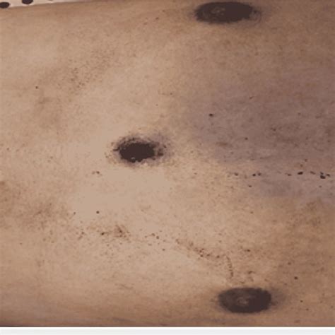 The Midline Of The Lower Part Of The Chest Had A 0 5 Cm Circular Defect Download Scientific