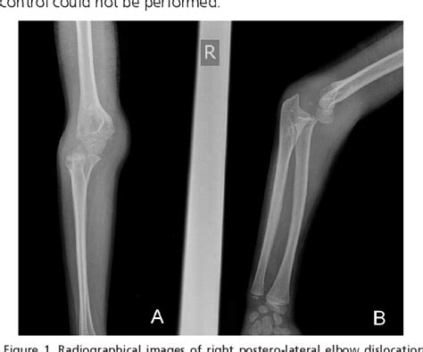 Posterior Elbow Dislocation