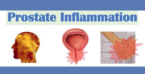 Chronic Prostatitis Causes Symptoms Diagnosis And Treatment