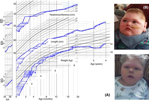 Microcephaly Growth Chart