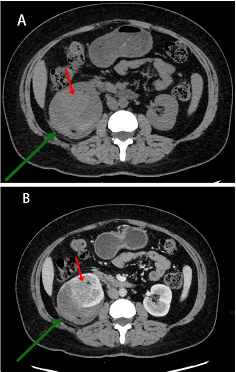 Figure 1 From A Case Report Of Chromophobe Renal Cell Carcinoma With