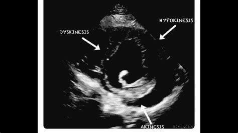 Hypokinesia Dyskinesia And Akinesia In A Single Echocardiography Frame Youtube