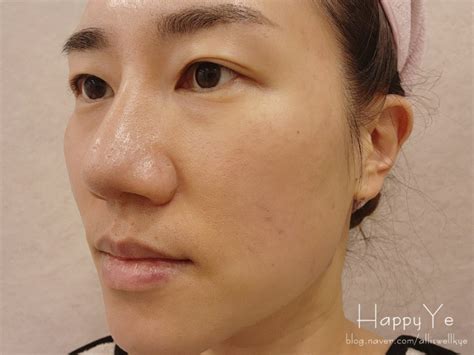 강남피부과 디스커버리 피코토닝 비타민 관리 후기 가격 통증 효과 네이버 블로그