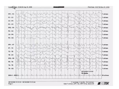 Abnormal Eeg Patterns Ppt