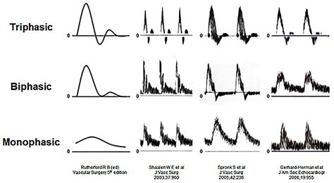 Interpretation Of Peripheral Arterial And Venous Doppler 48 Off