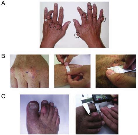 Physical Assessment Of Subcutaneous Tophi A Counting The