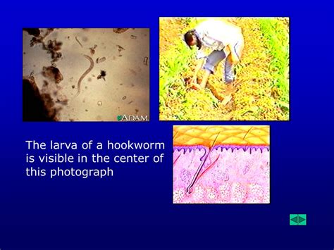 Hookworms Associated Prof Tian Ppt Video Online Download