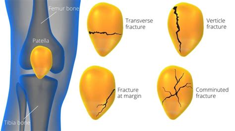 Patella Fracture Classification Floating Knee Injuries In Adults And