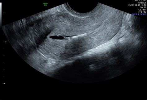 Sonohysterography South Coast Ultrasound For Women