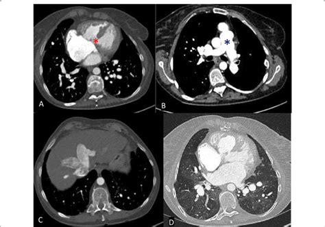 Select Axial Ct Images In The Bone A And C Soft Tissue B And Lung