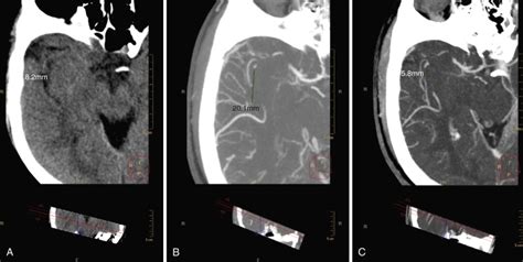 Stroke Radiology Key