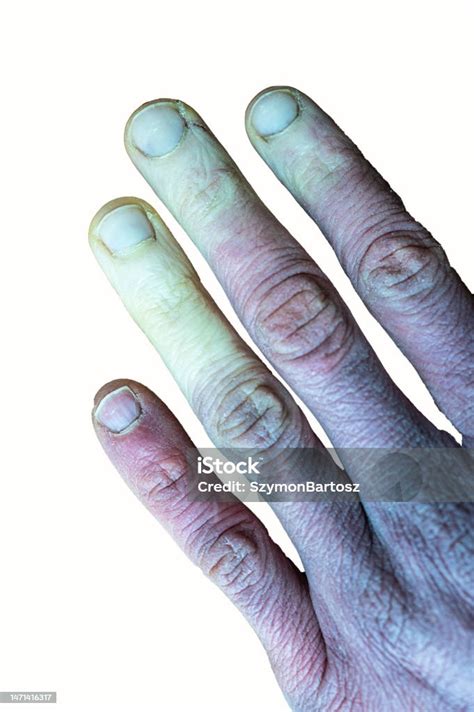 레이노 증후군 레이노 현상 또는 레이노병을 앓고 있는 동상에 걸린 남성의 손이 휘 배경에 고립되어 있습니다 감각 지각에 대한 스톡 사진 및 기타 이미지 Istock