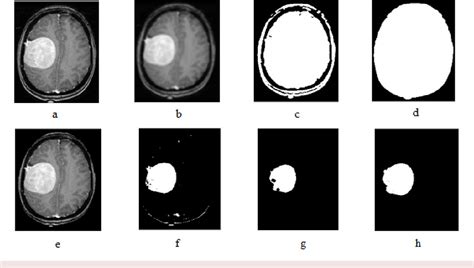 figure 1 from optimization of brain tumor mr image classification