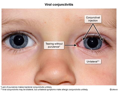 Conjunctivitis Infectious Diseases Uworld Medical Library