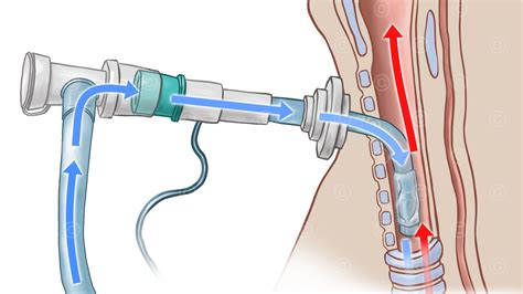 Illustrations Tracheostomy Management Medicalgraphics