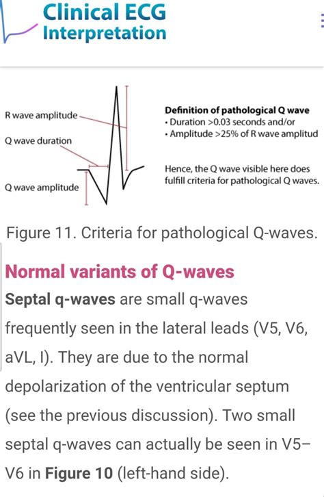 Pathological Q Wave
