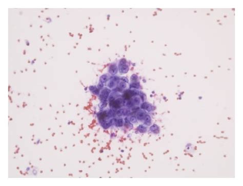 Csf Cytospin Smear Showing Atypical Cells In Small Clusters With Download Scientific Diagram