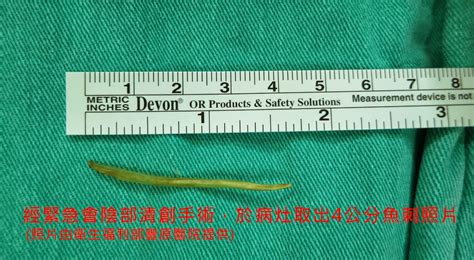 中華鱻傳媒 一根魚刺的奇幻漂流 取出4公分長魚刺