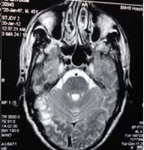 Mri Of The Brain T2w Axial Section Showing Infarct In The Right Pca