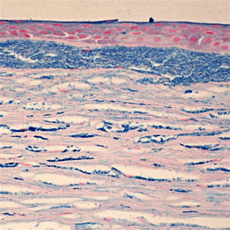 Posterior Polymorphous Corneal Dystrophy Immunohistochemical Download Scientific Diagram