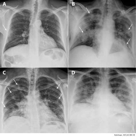Pnuemonia On A Chest X Ray
