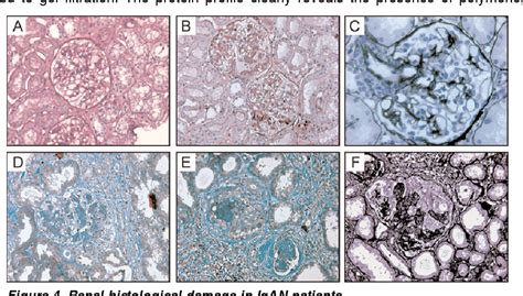 Figure 1 From Glomerular Activation Of The Lectin Pathway Of Complement