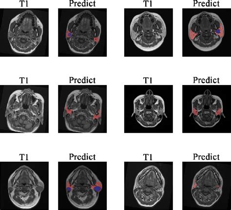 Figure 1 From Parotid Gland Mri Segmentation Based On Swin Unet And Multimodal Images Semantic