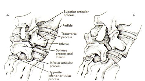 Scottie Dog Sign Ars Neurochirurgica