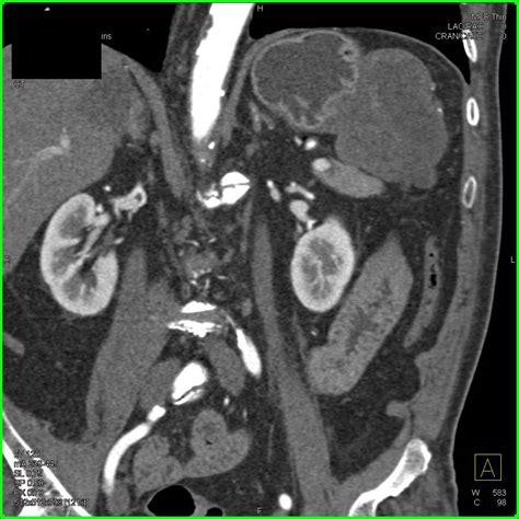 Gastric Gist Tumor Stomach Case Studies Ctisus Ct Scanning