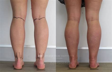 Calves Liposuction Before And After At Delia Garibay Blog