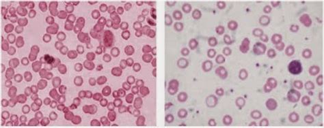 Fichero De Hematología Anormalidades De Los Eritrocitos